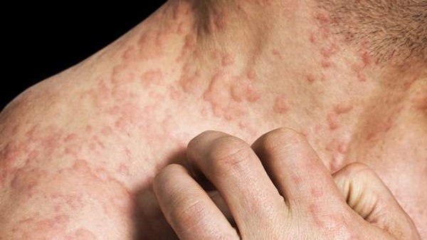 90% Kes Kanser Kulit Berpunca Dari Cahaya Matahari, Kulit Cerah Lebih ...