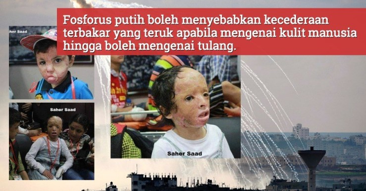 Bukan Mekap 'Special Effect', Viral Muka Cacat Kanak-Kanak Gaza Didakwa ...