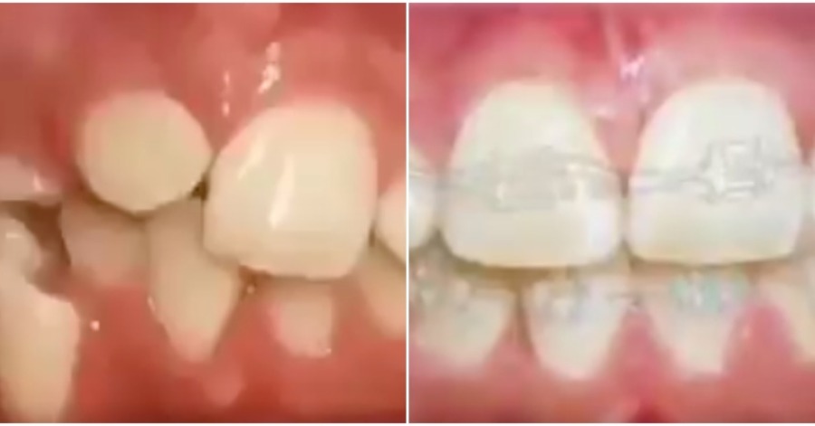 (Video) Macam Mana ''Braces'' Betulkan Gigi Berterabur, Ini Proses Yang ...