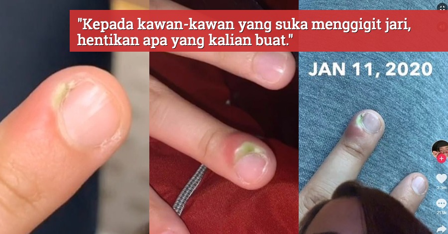Gara-Gara Tabiat Suka Gigit Kuku, Jari Gadis Ini Bernanah & Nyaris Kena ...