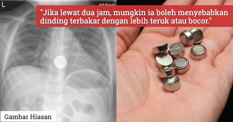 “Berderau Darah Tengok Anak Telan Bateri”, Dinding Esofagus Anak ...