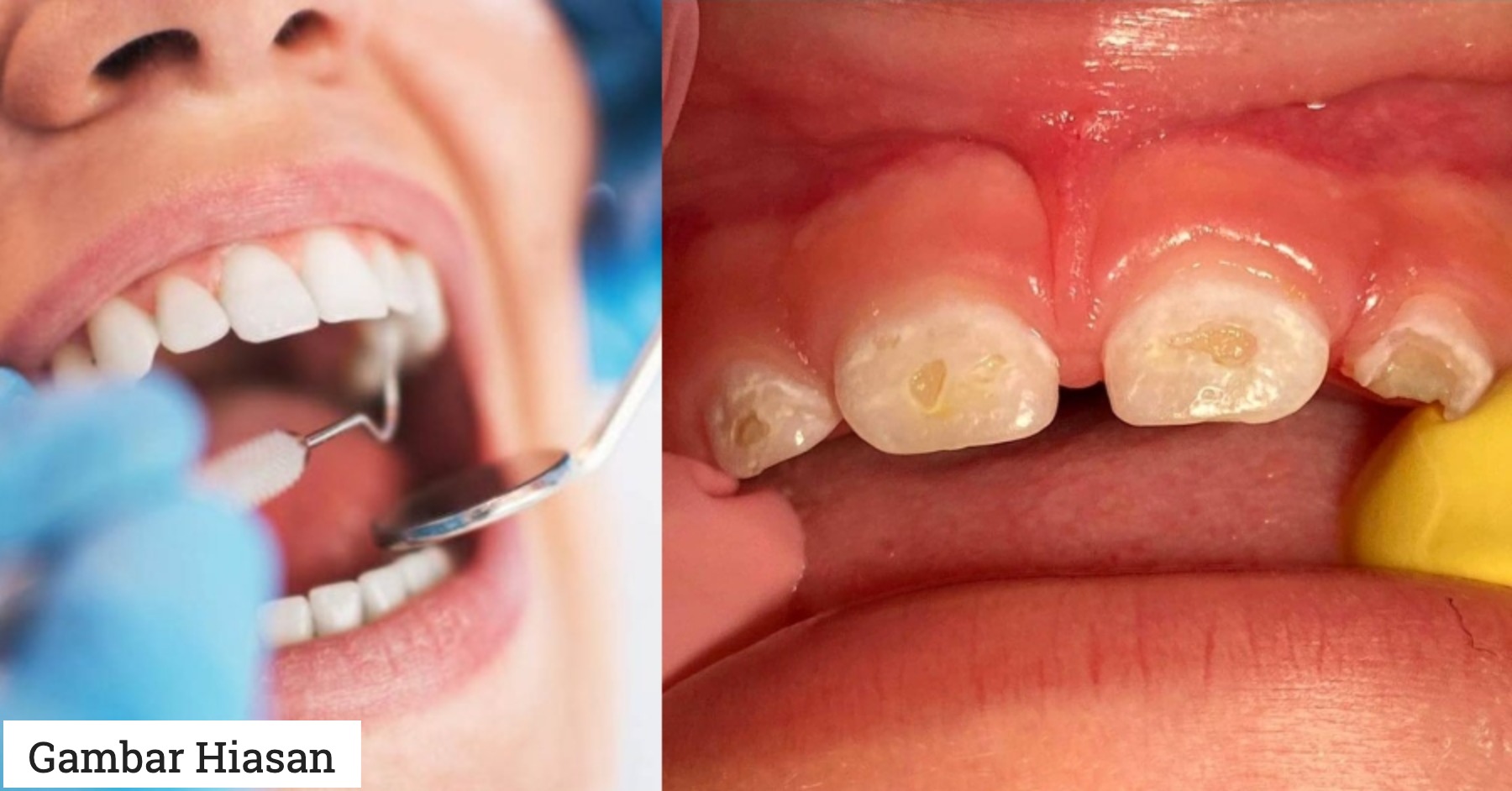 Kesan Lubang Bukanlah Punca Awal Gigi Rosak, Doktor Dedahkan Tanda Kerosakan Gigi Yang Kena ...