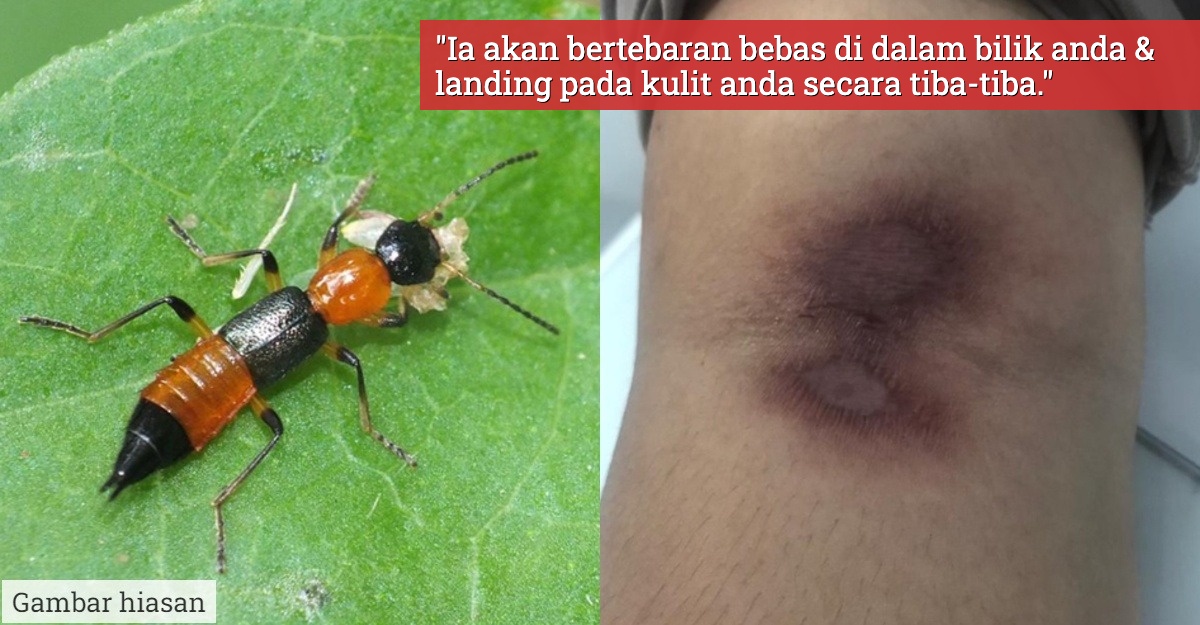 "Jangan Tepuk Kalau Ia 'Landing' Pada...", Doktor Dedah Bahaya Charlie ...