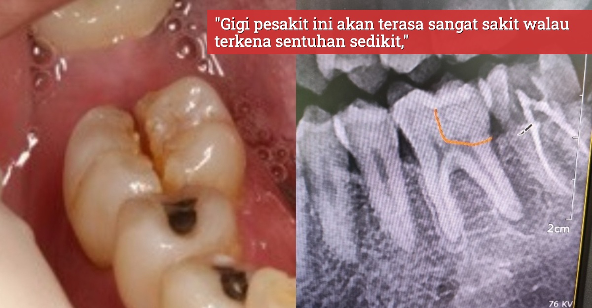"Nak Gigit Sakit," Gigi Retak Sampai Ke Akar, Doktor Ini Pesan Jangan Suka Kunyah Benda Keras