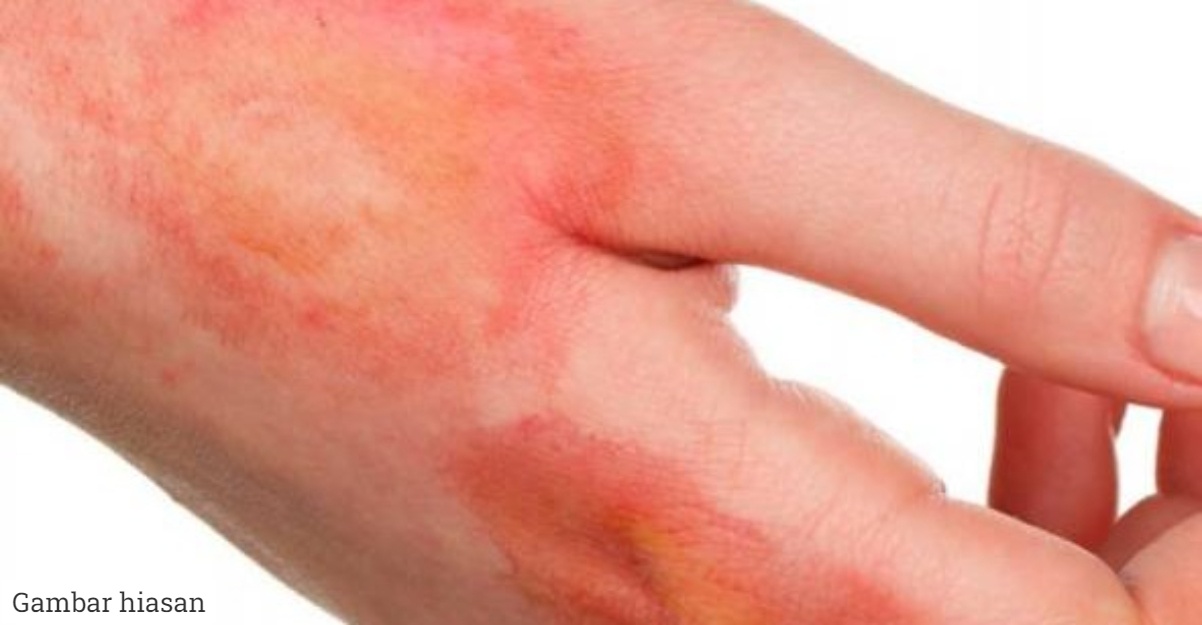 Ini Kenapa Luka Kebakaran Boleh Membawa Kematian