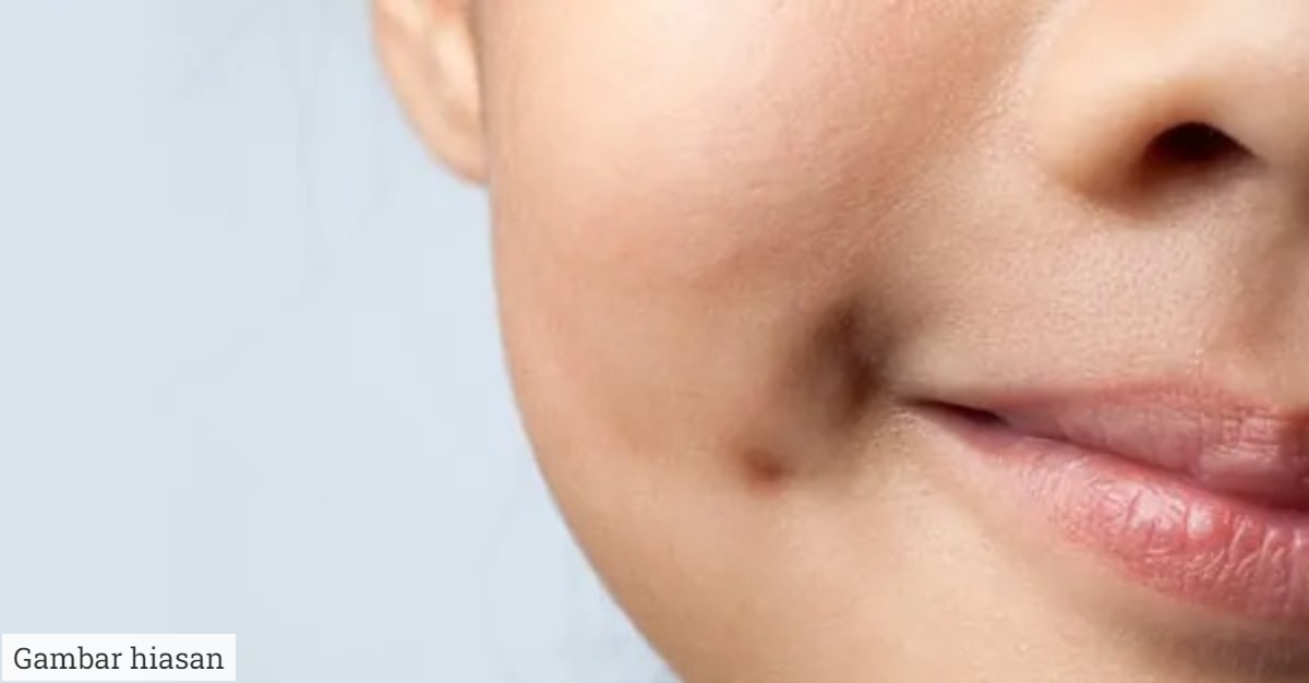 Banyak Bahaya Menanti, Ini Risiko Jika Buat Lesung Pipit Palsu